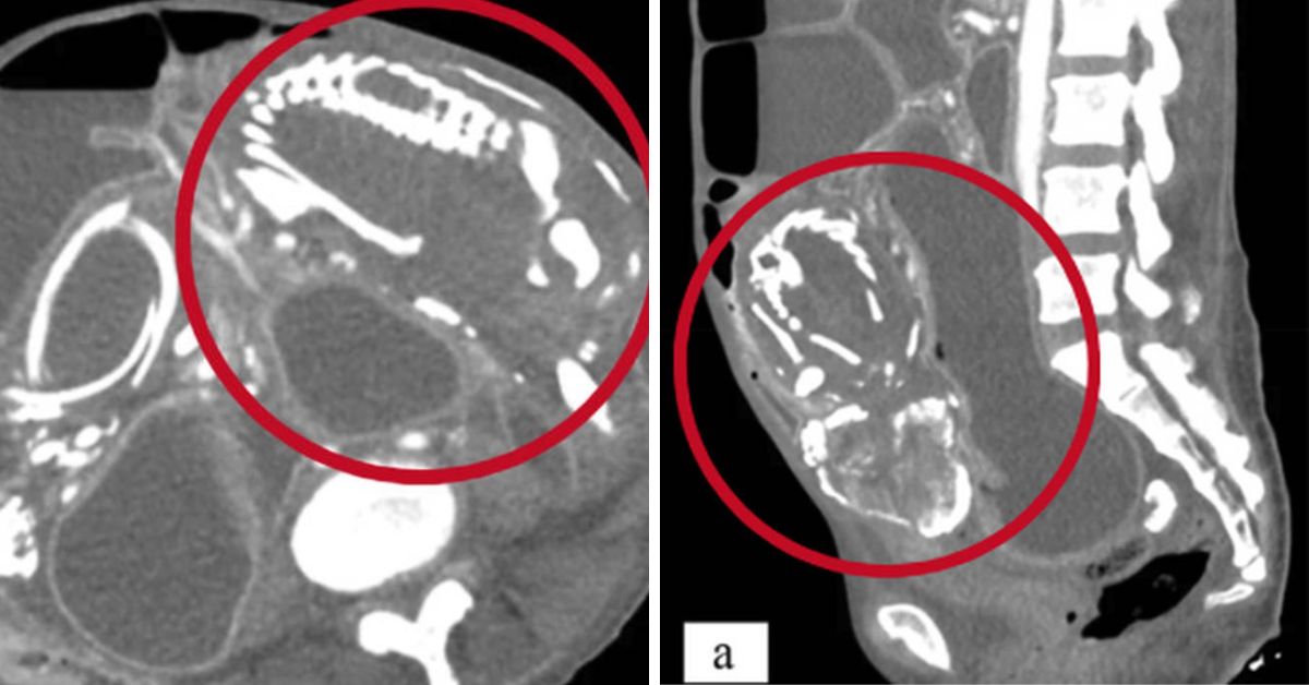 Litopedia: la extraña condición en la que un feto se 'momifica' en su madre