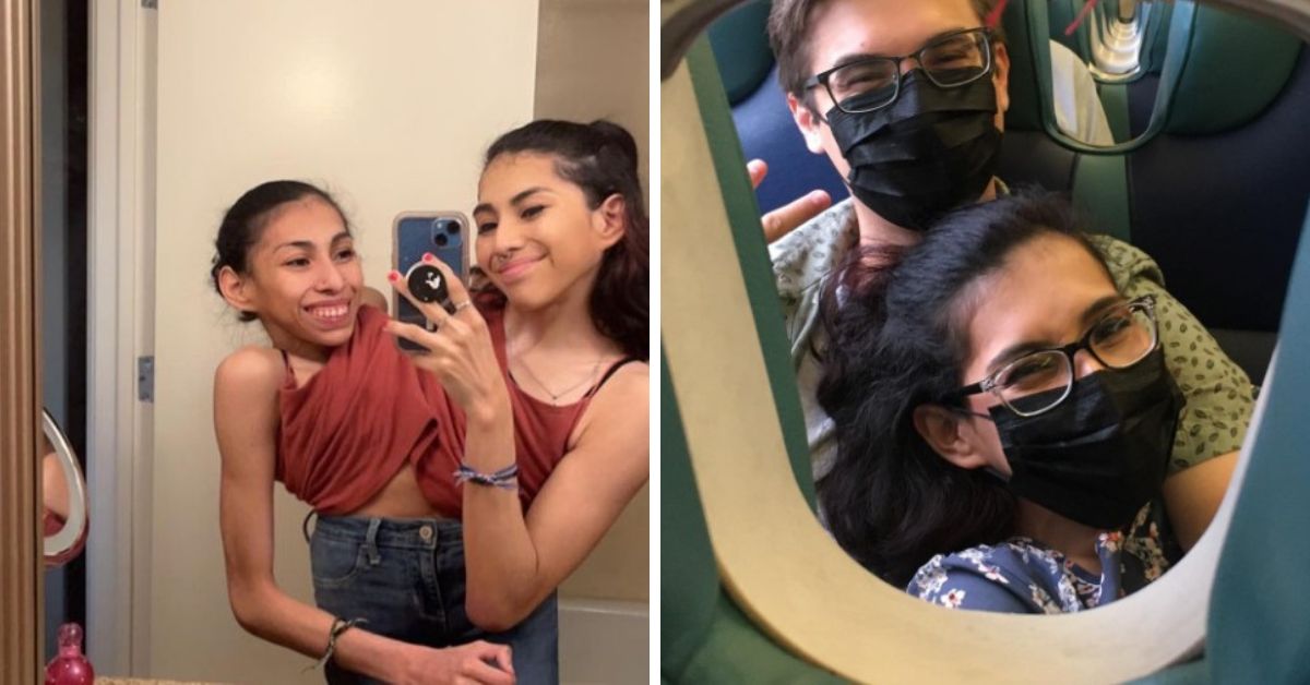 Siamesas comparten órganos, pero llevan diferentes vidas amorosas