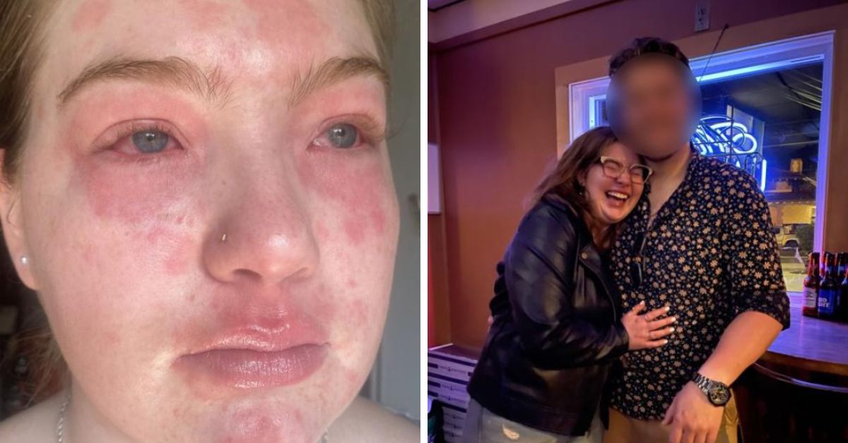 Se brota y sus ojos lloran: mujer afirma que es alérgica a su novio